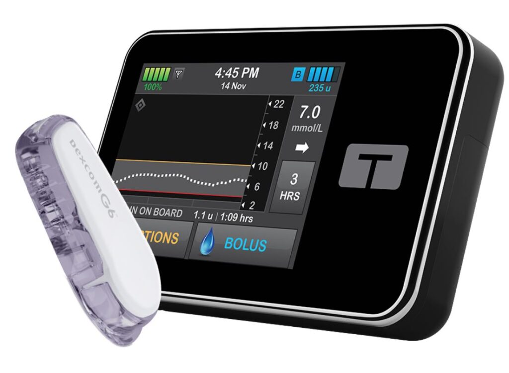 BiH iskustvo: Tandem inzulinska pumpa i closed loop - NaInzulinu.com